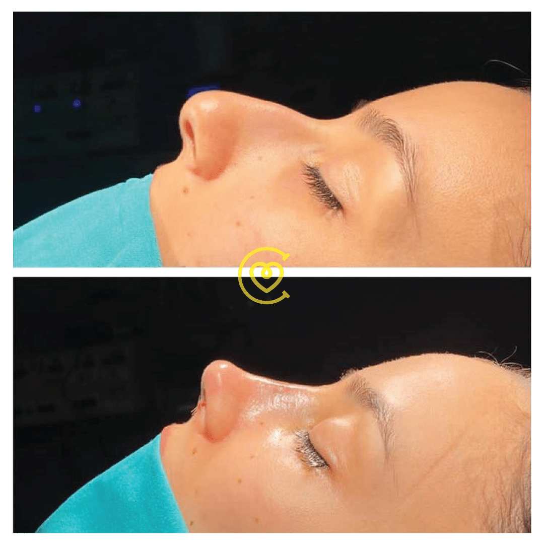 Alarplastika ar rinoplastika? | Supraskite skirtumą